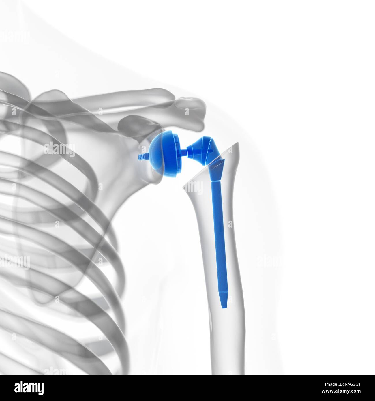 Illustration of a shoulder replacement Stock Photo - Alamy