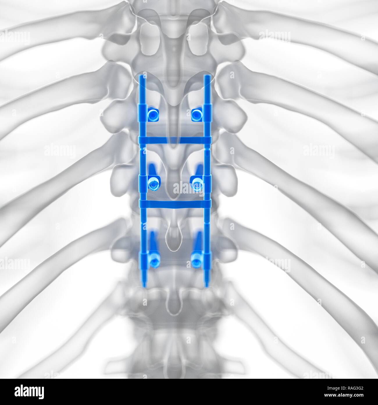 Illustration of a spinal fusion Stock Photo - Alamy