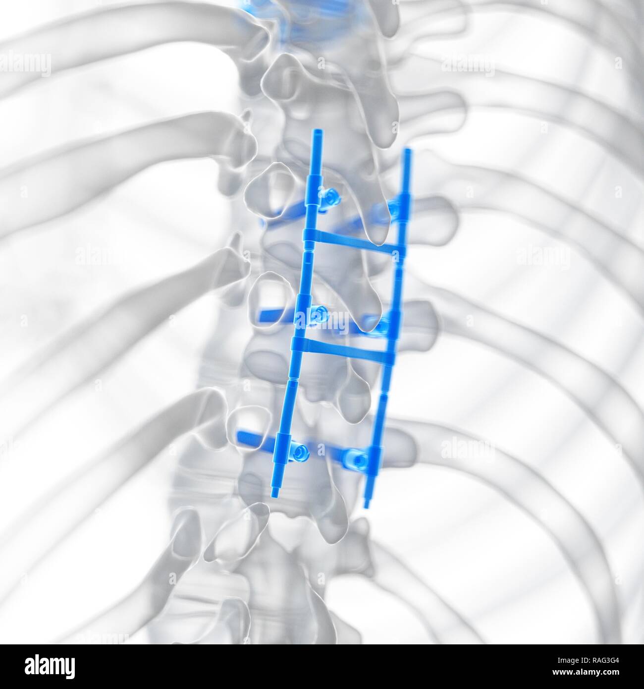 Illustration of a spinal fusion Stock Photo - Alamy