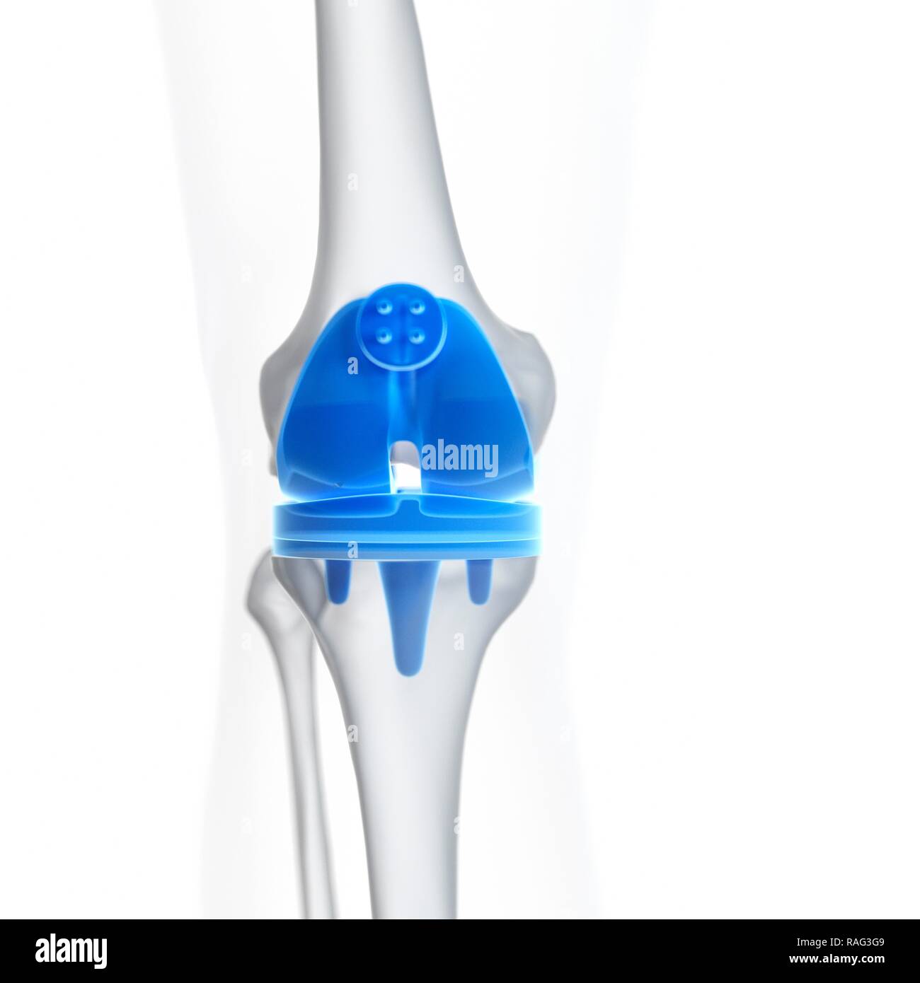Illustration of a knee replacement Stock Photo - Alamy