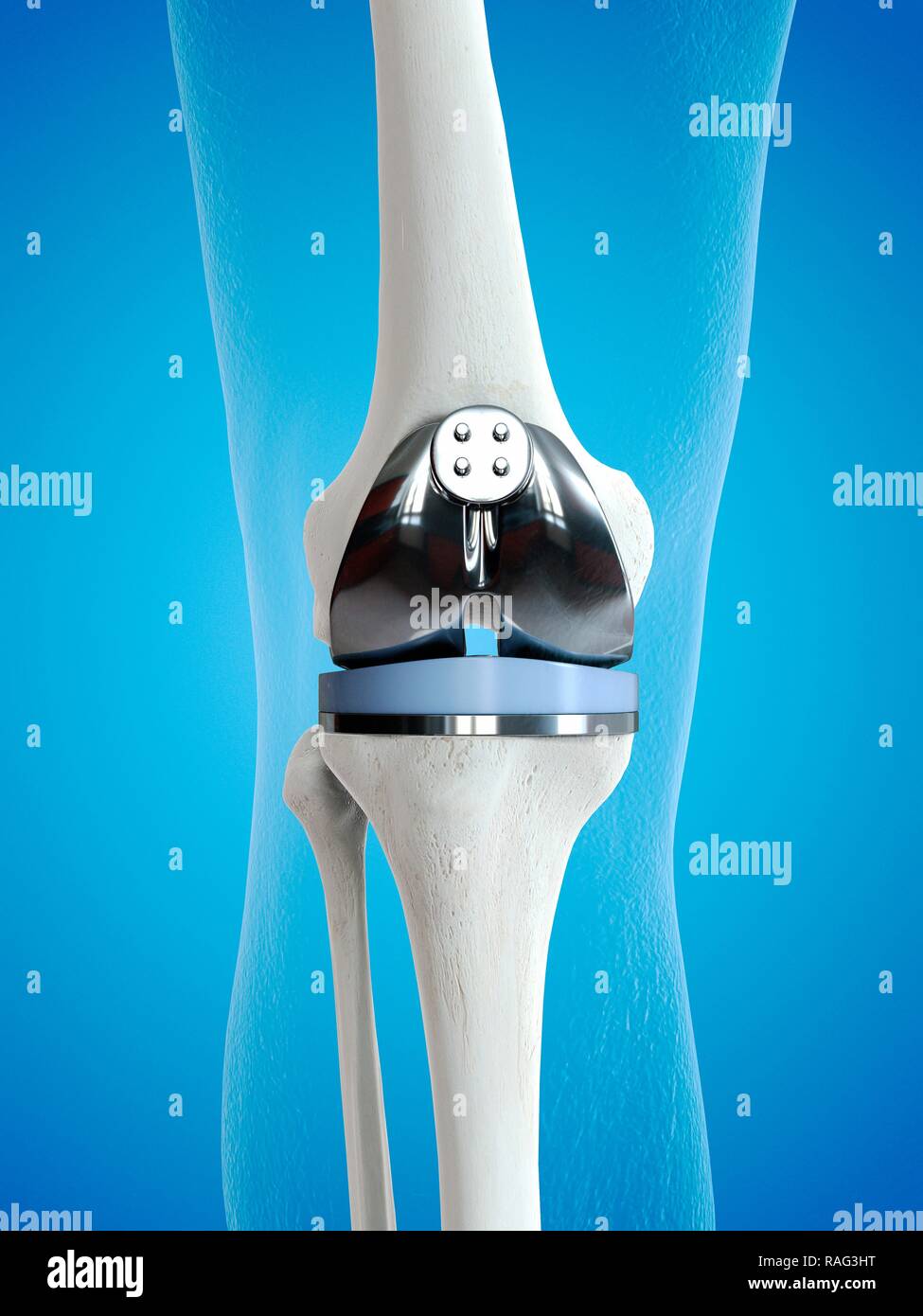 Knee joint replacement orthopedic hi-res stock photography and images ...