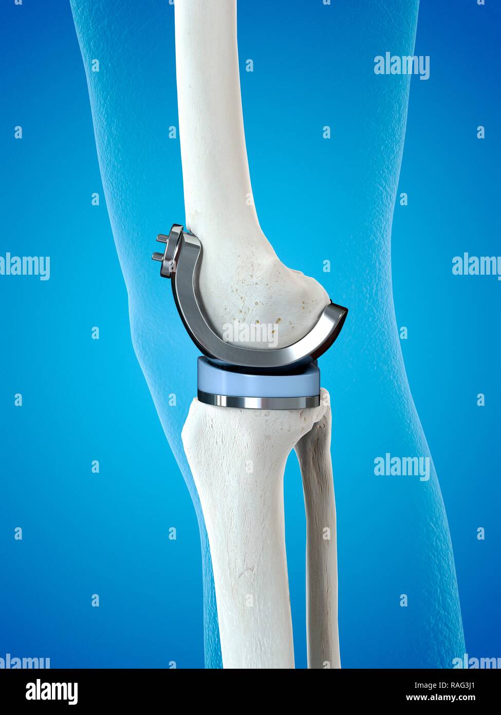 Illustration of a knee replacement Stock Photo - Alamy