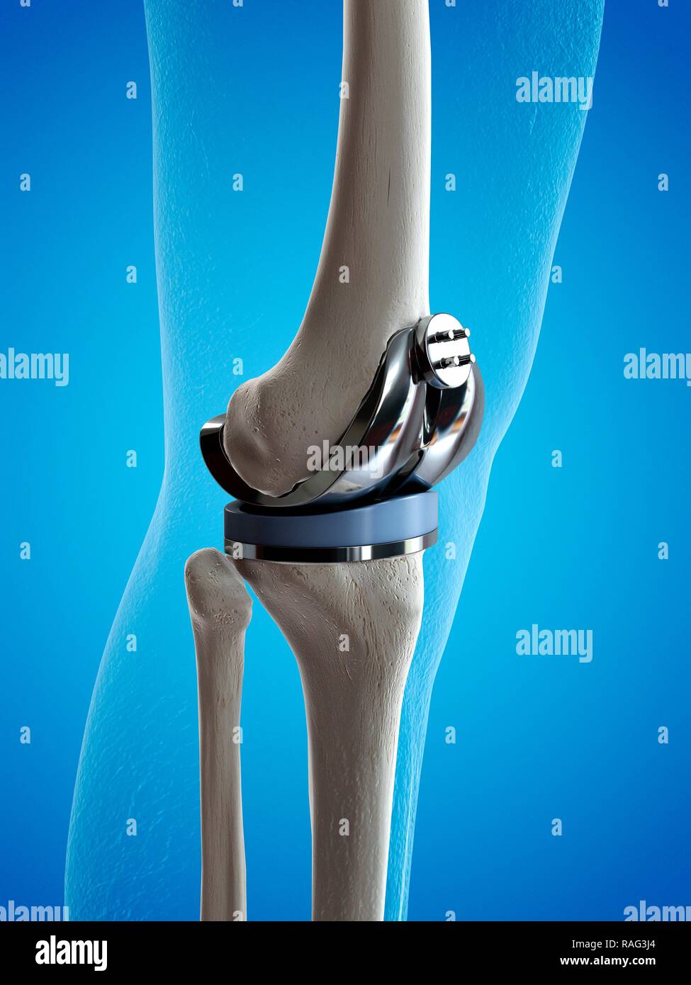 Knee replacement hi-res stock photography and images - Alamy