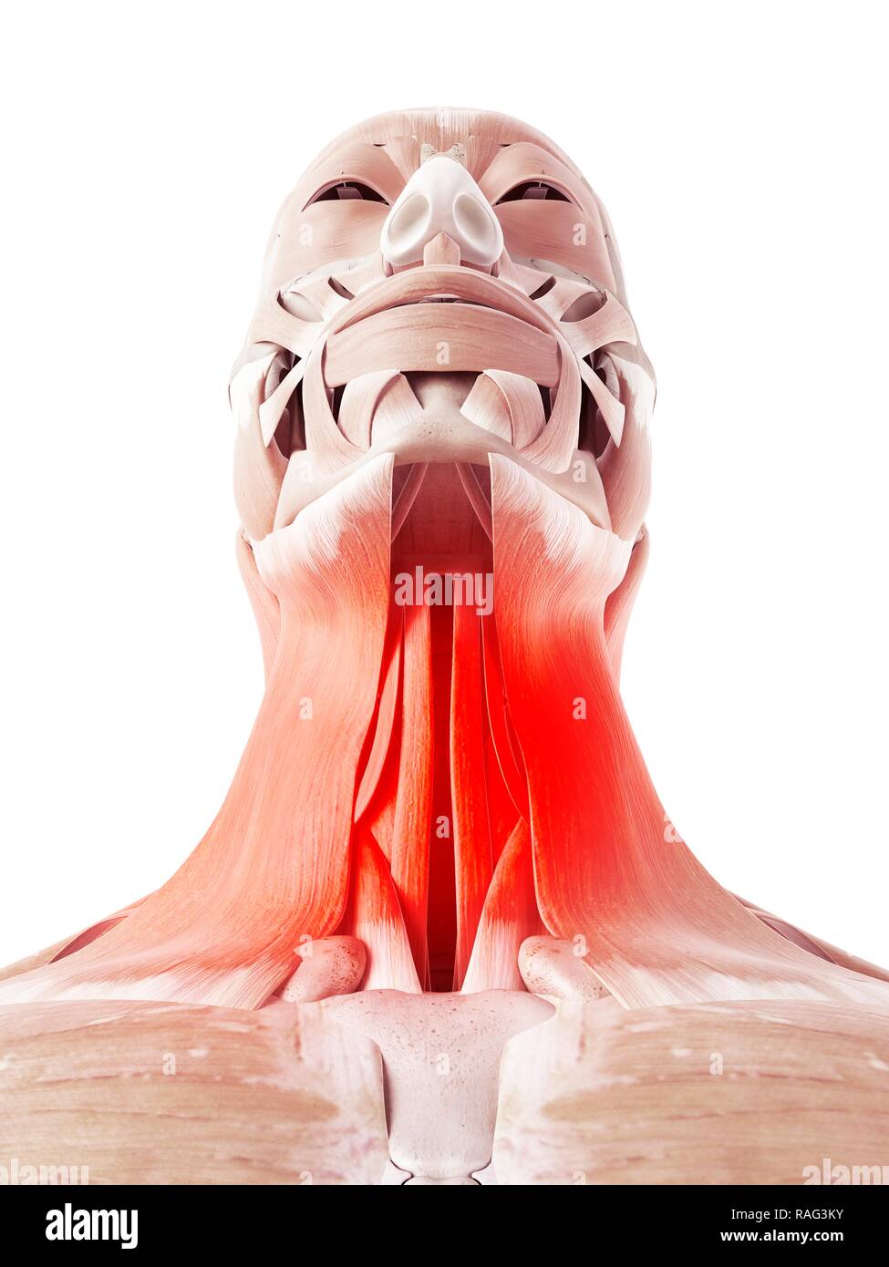 Illustration of painful neck muscles Stock Photo - Alamy