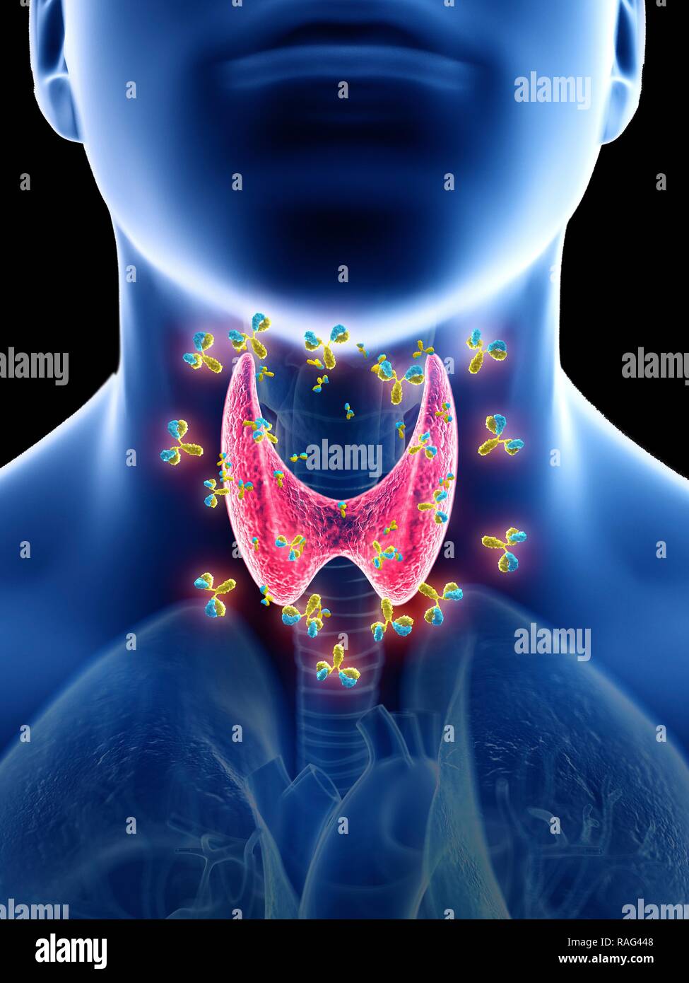 Graves disease hi-res stock photography and images - Alamy