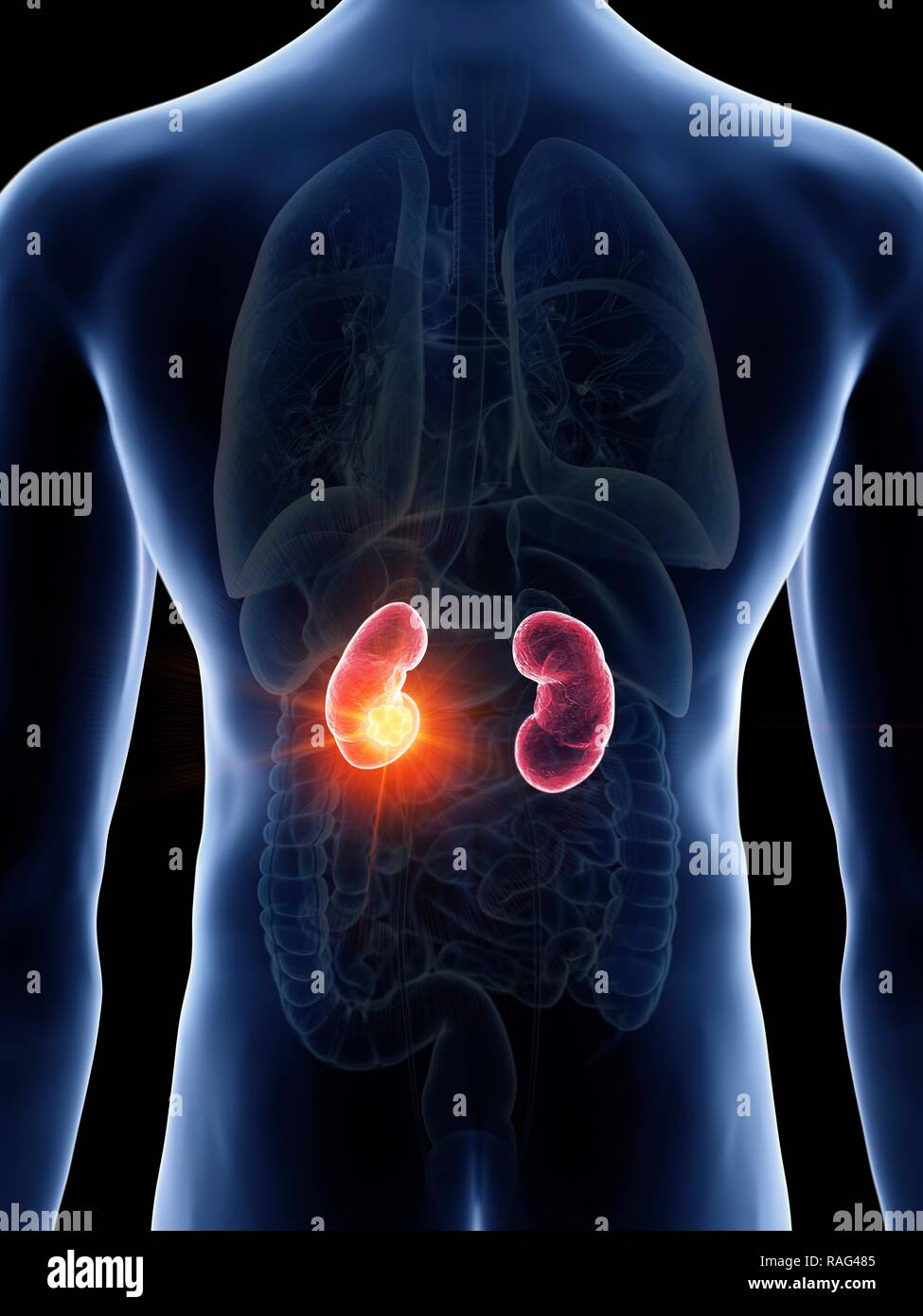 Illustration of a man's kidney cancer Stock Photo - Alamy