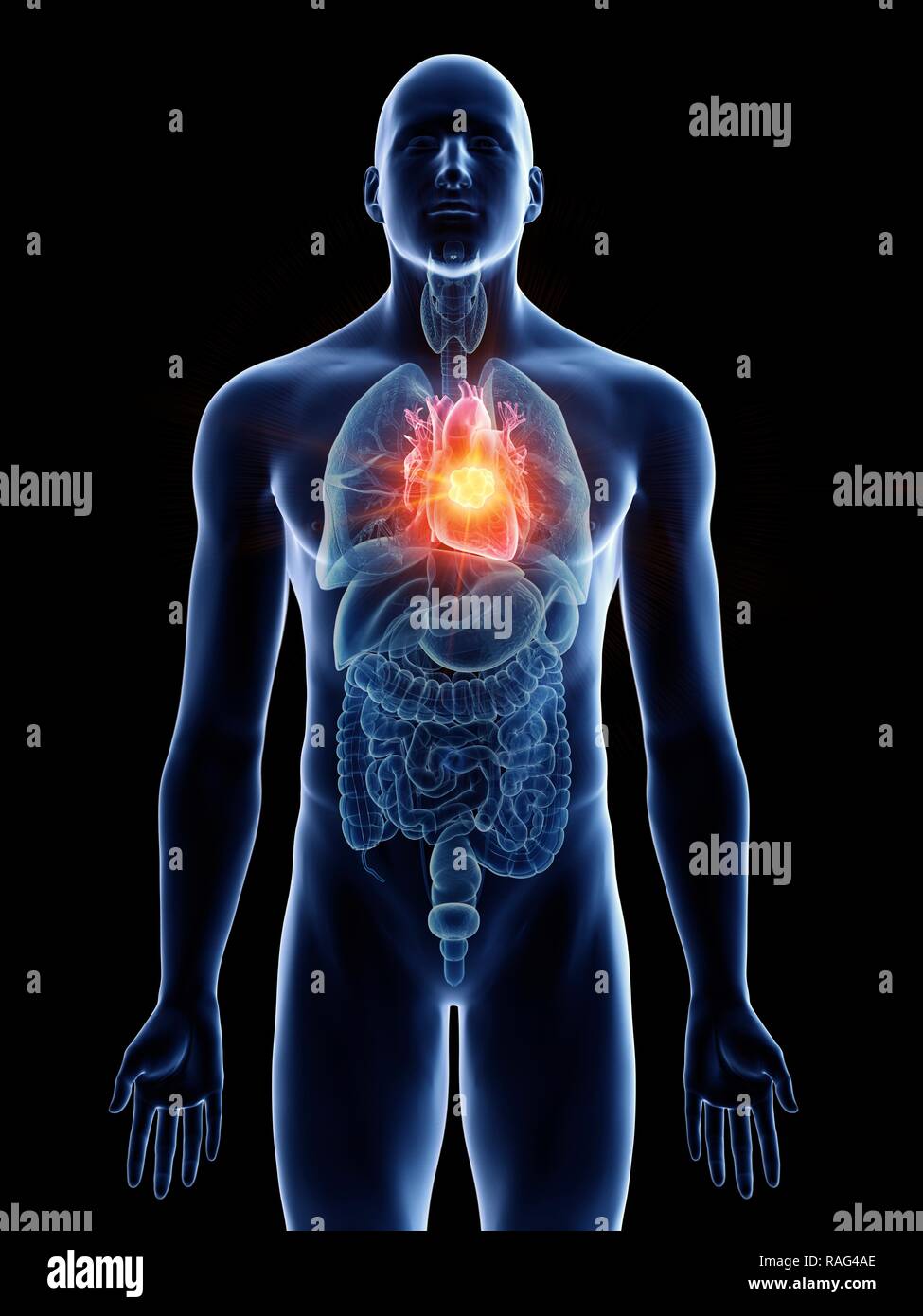 Vascular tumour hi-res stock photography and images - Alamy
