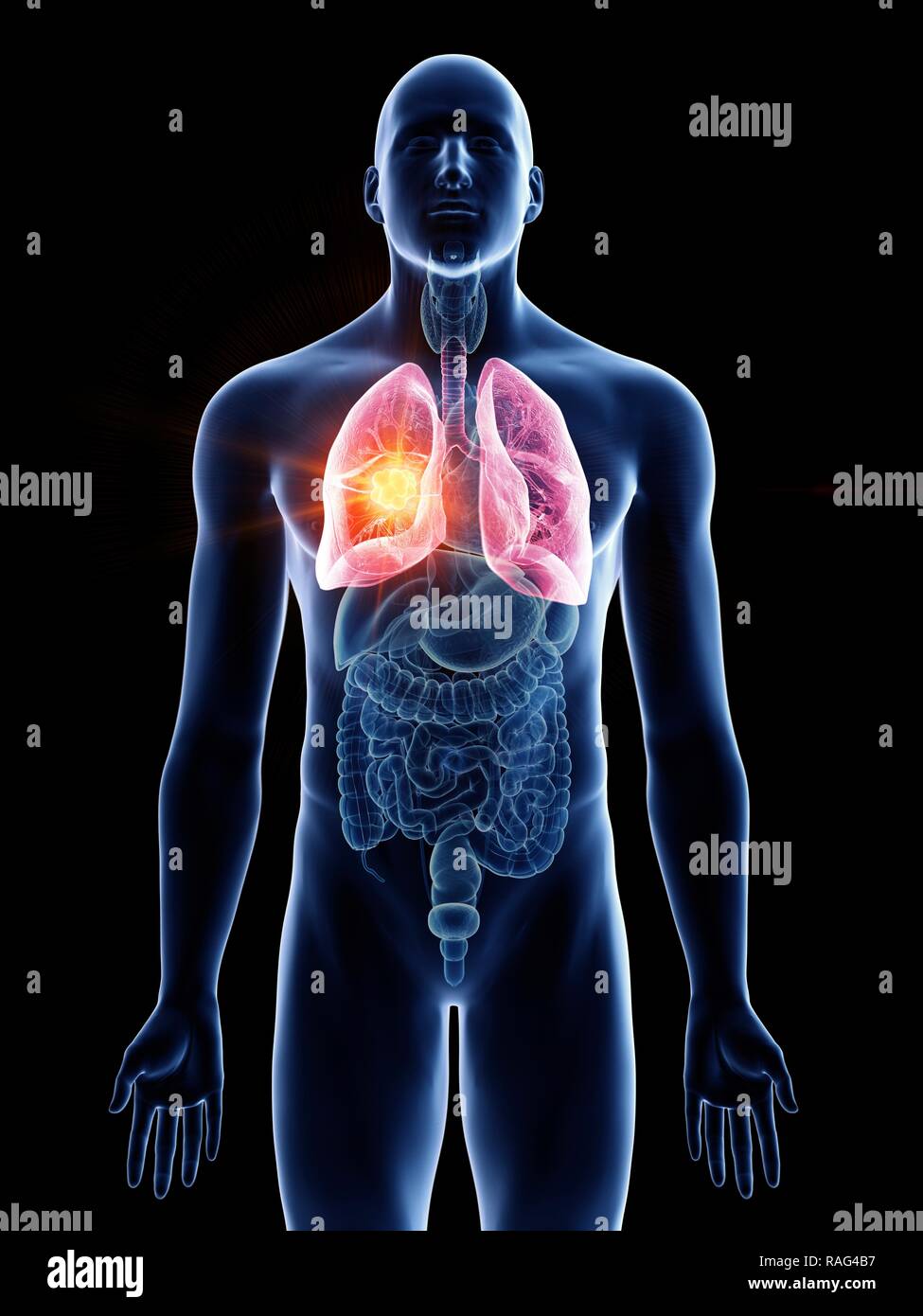 Illustration of a man's lung cancer Stock Photo - Alamy