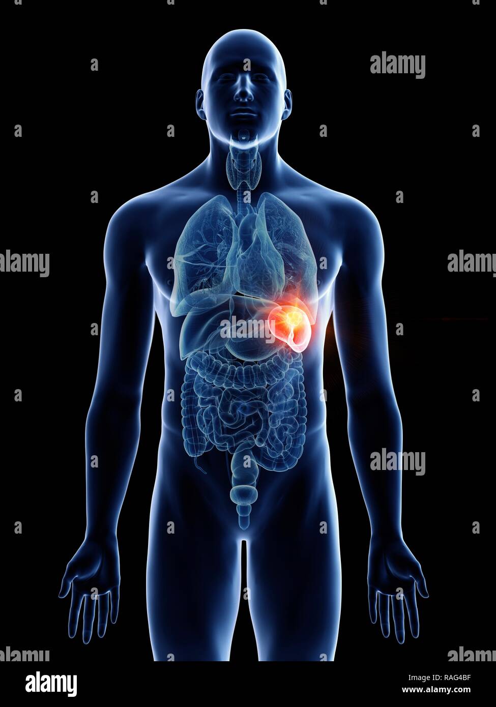 Illustration of a man's spleen cancer Stock Photo - Alamy