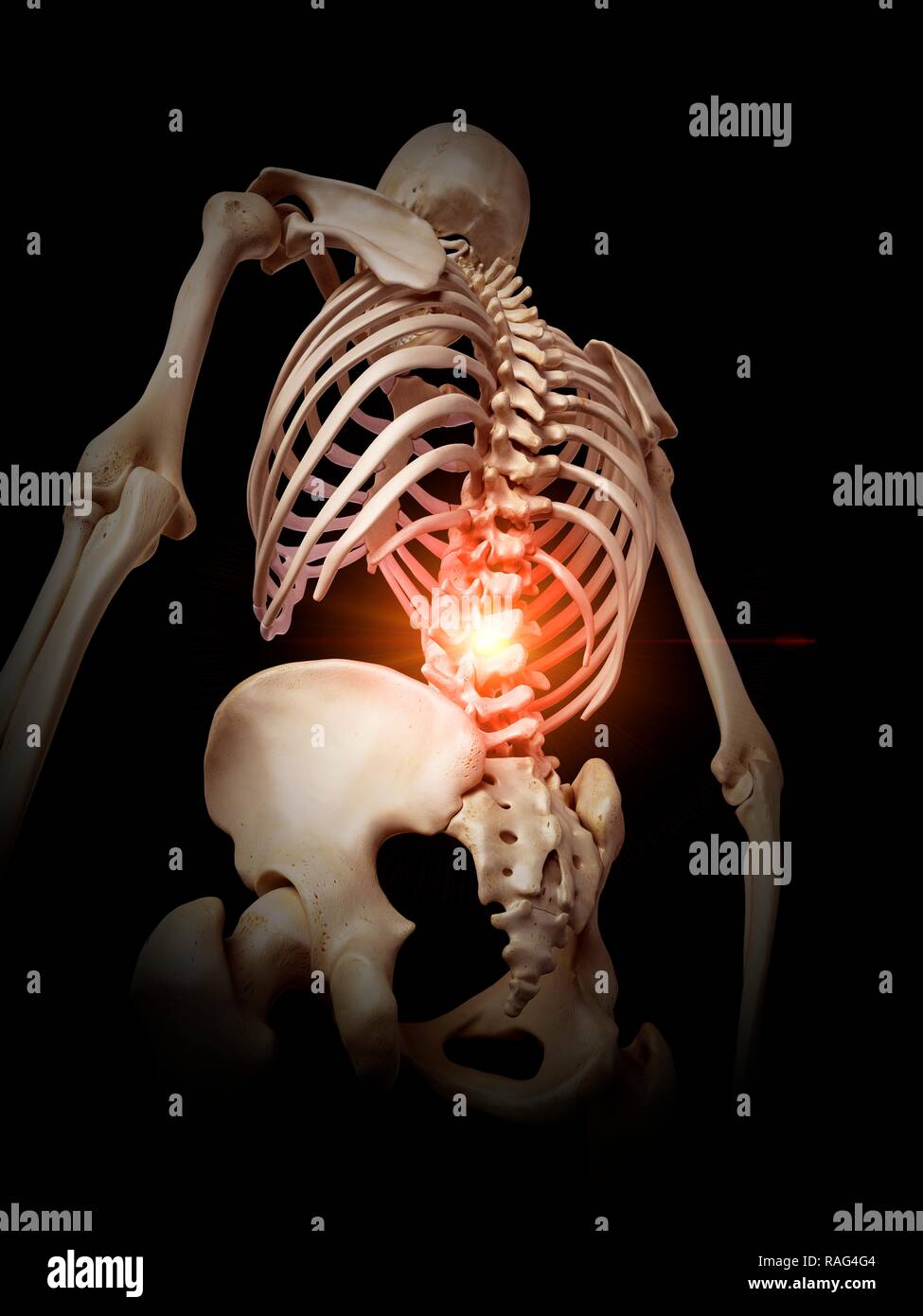 Illustration of a painful spine Stock Photo - Alamy