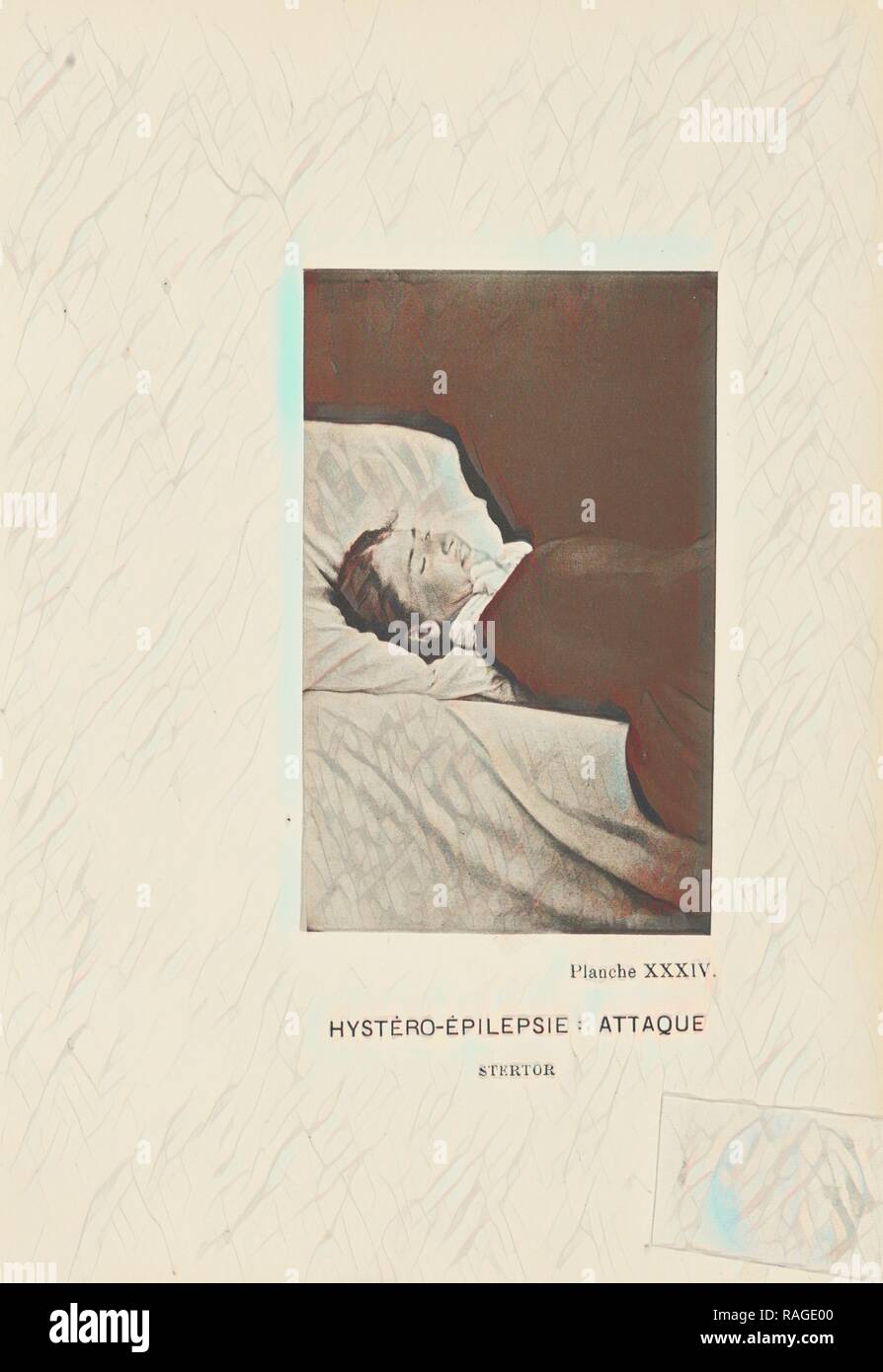 Hystéro-Épilepsie: Attaque Stertor, Paul-Marie-Léon Regnard (French ...