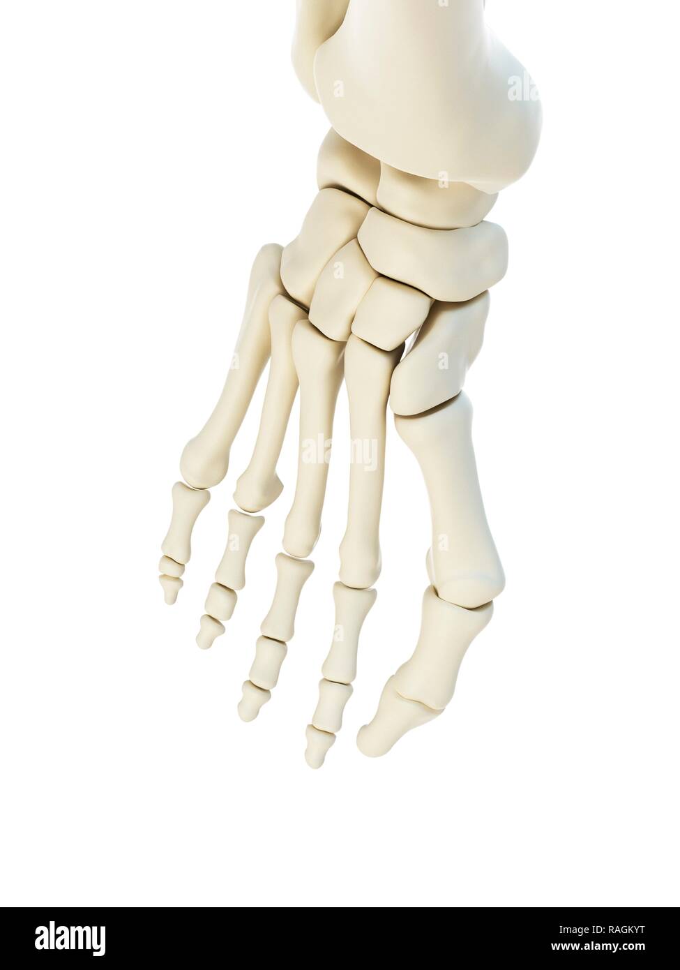 Illustration of a bunion Stock Photo - Alamy