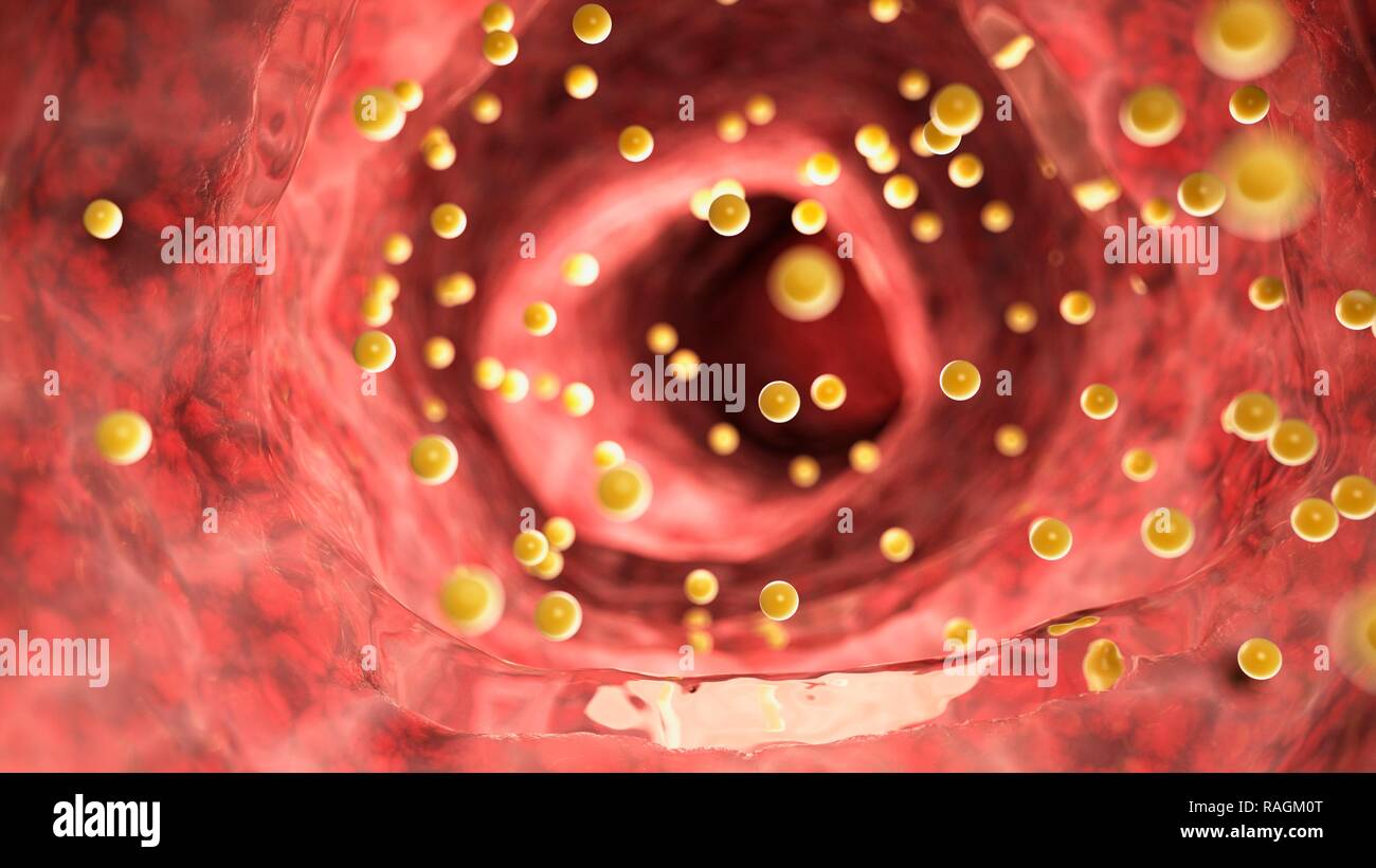 Illustration of colon inflammation caused by gluten Stock Photo - Alamy