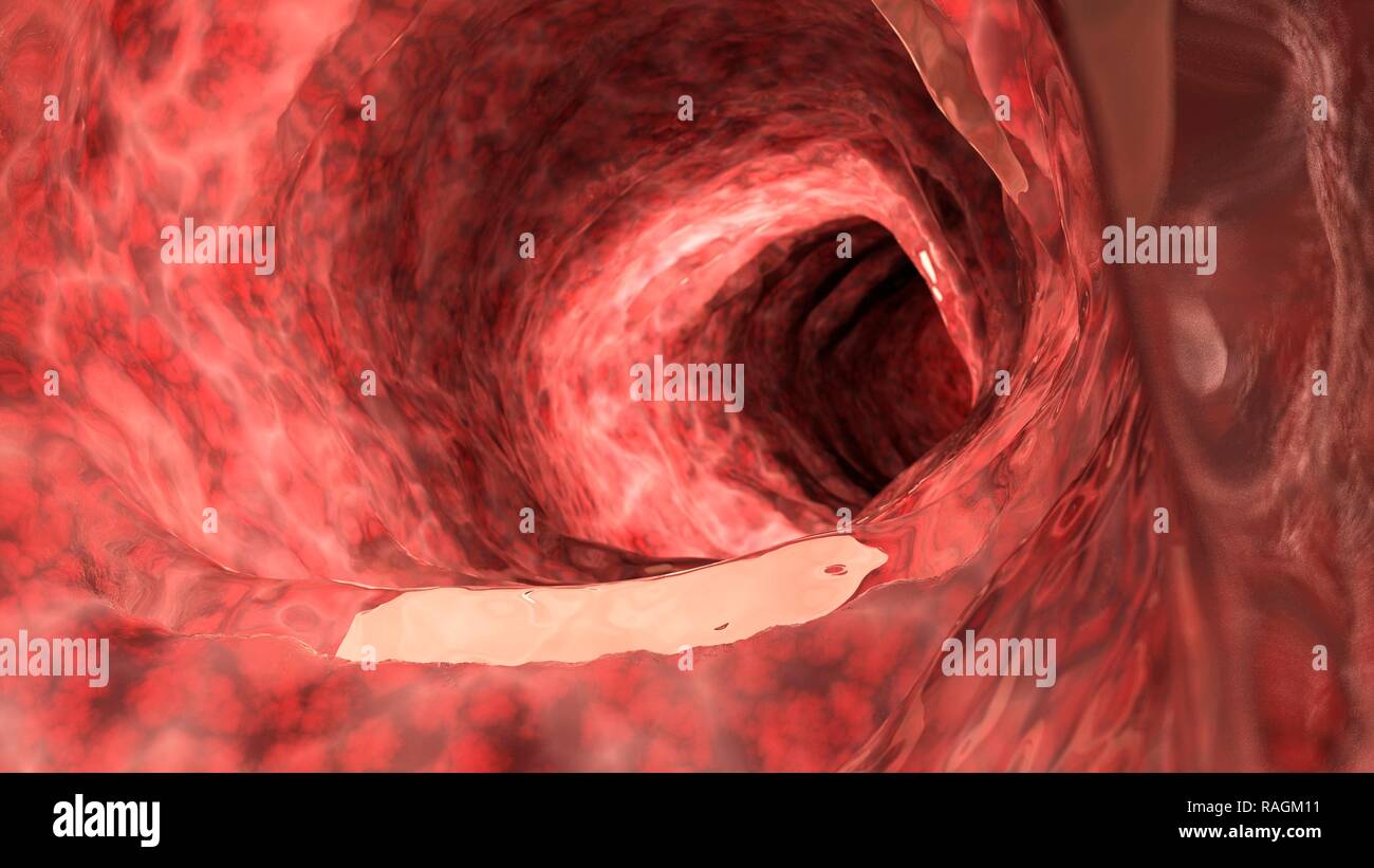 Inflamed intestinal villi hi-res stock photography and images - Alamy