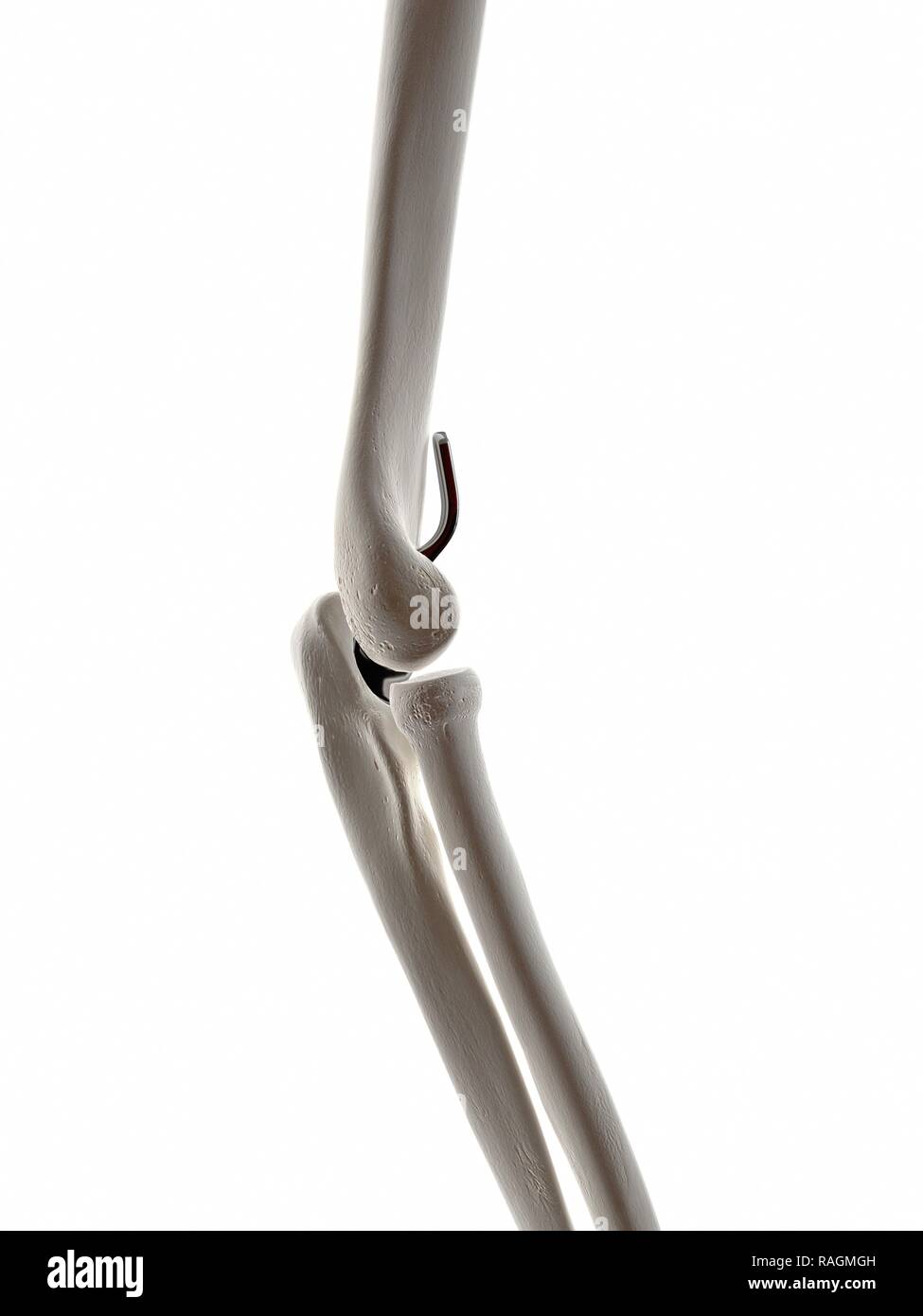 Illustration of an elbow implant Stock Photo - Alamy