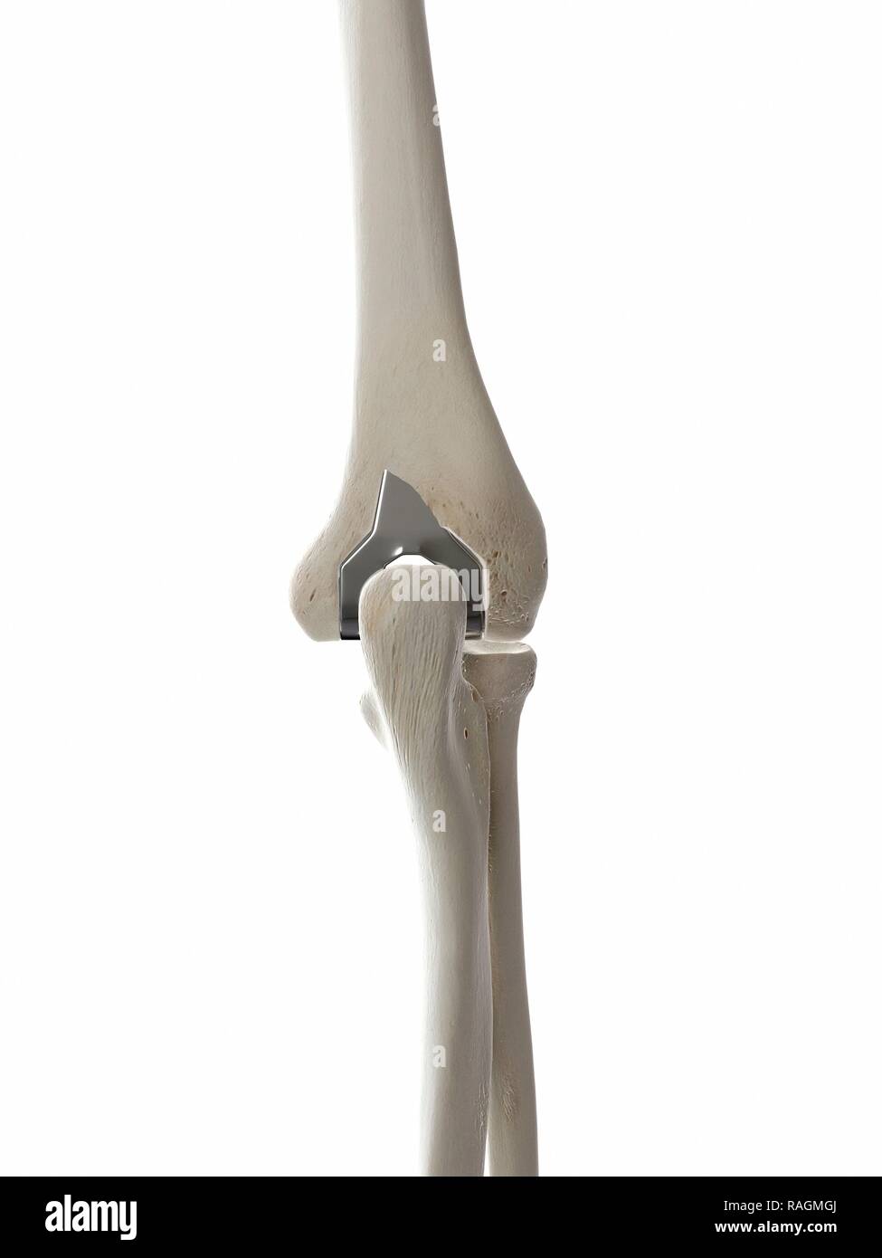 Illustration of an elbow implant Stock Photo - Alamy