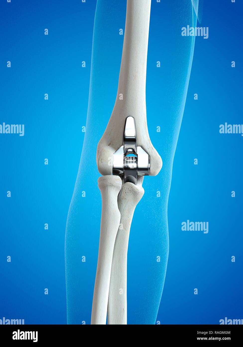 Illustration of an elbow replacement Stock Photo - Alamy