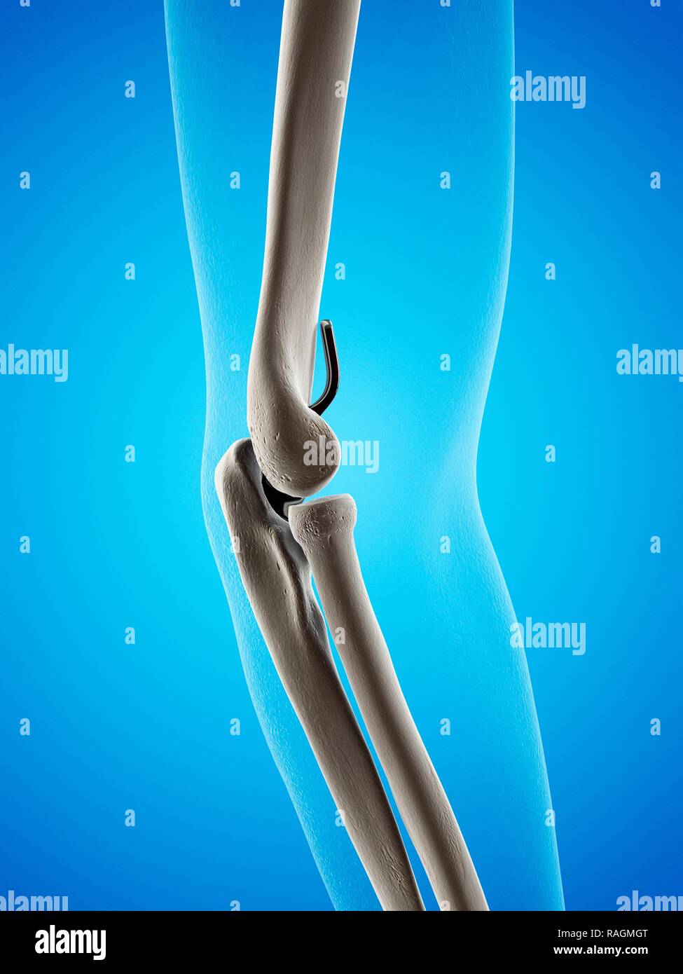 Elbow replacement hi-res stock photography and images - Alamy
