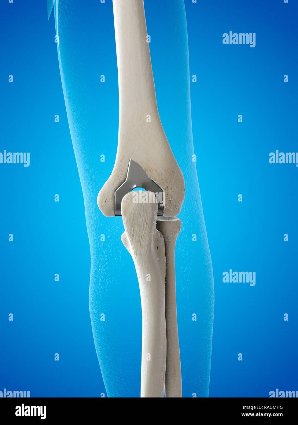 Elbow replacement hi-res stock photography and images - Alamy
