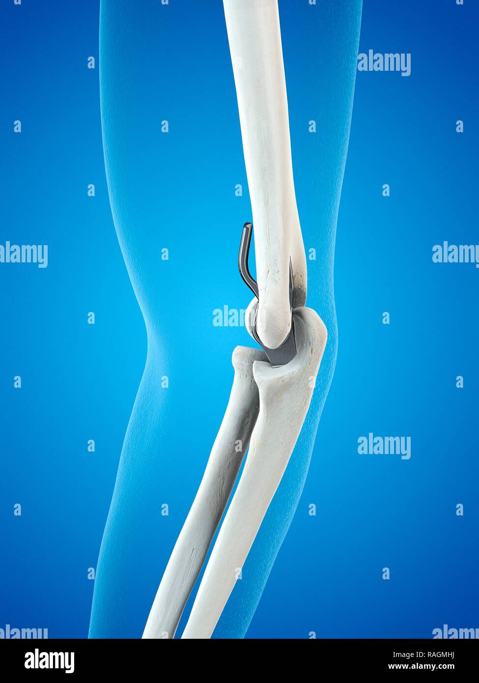 Elbow replacement hi-res stock photography and images - Alamy