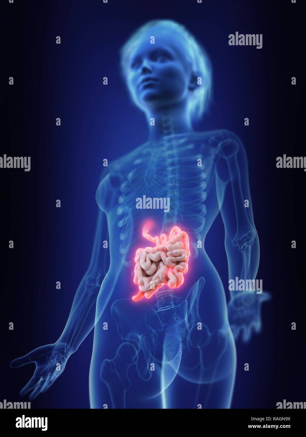 Illustration of an inflamed small intestine Stock Photo - Alamy