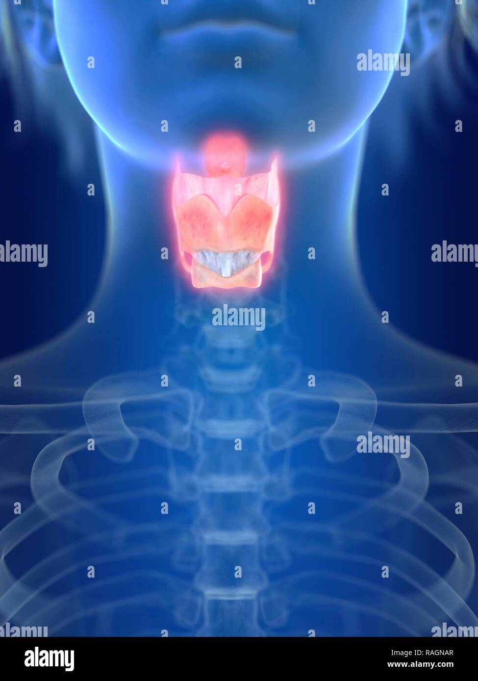 Illustration of an inflamed larynx Stock Photo - Alamy