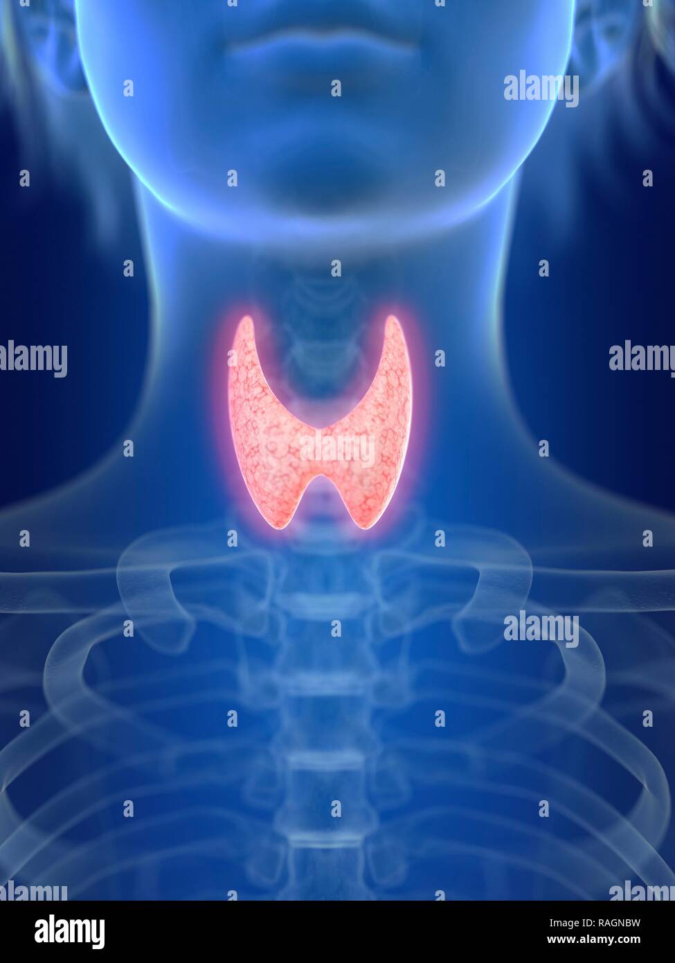 Illustration of an inflamed thyroid gland Stock Photo - Alamy