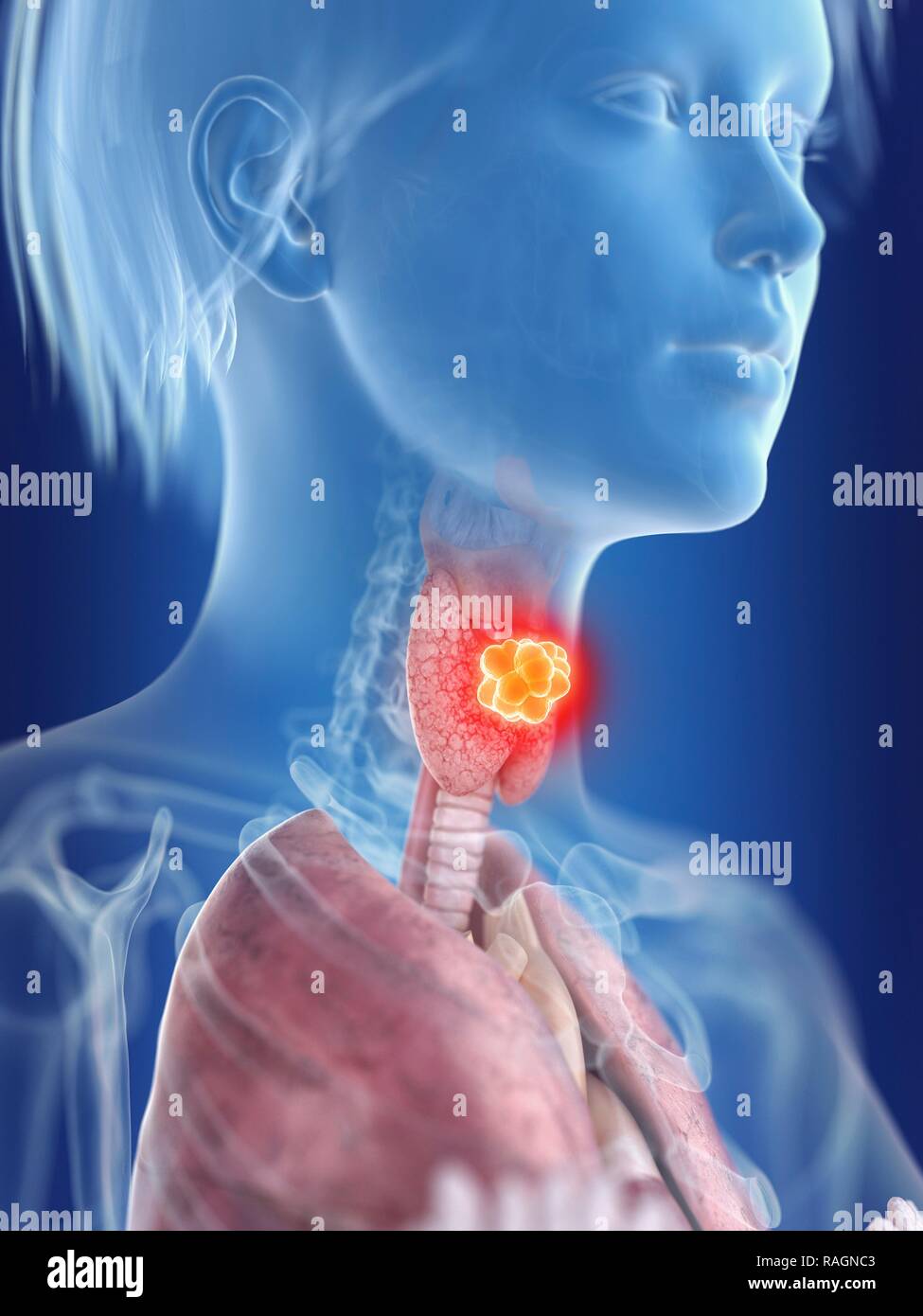 Illustration of a woman's thyroid gland cancer Stock Photo - Alamy