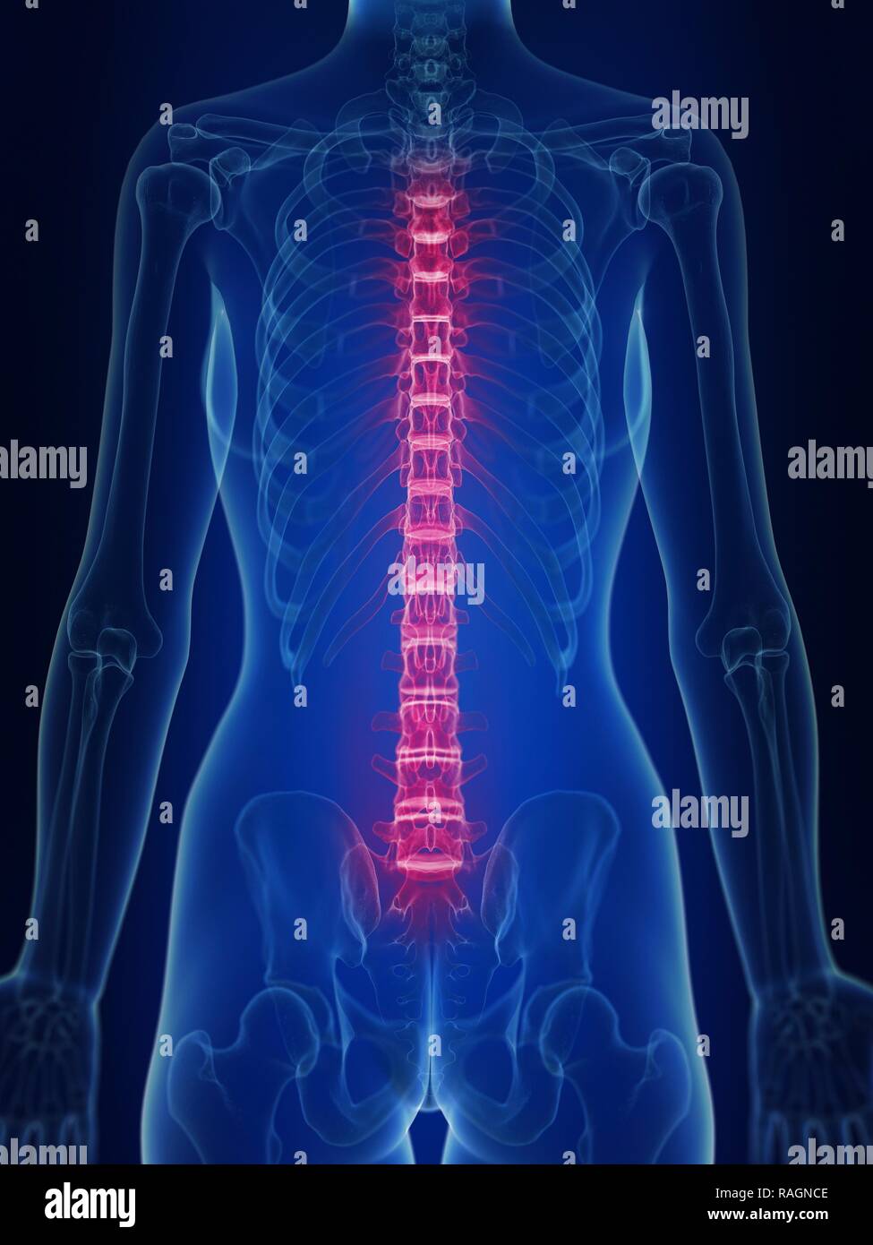 Illustration of painful back Stock Photo - Alamy