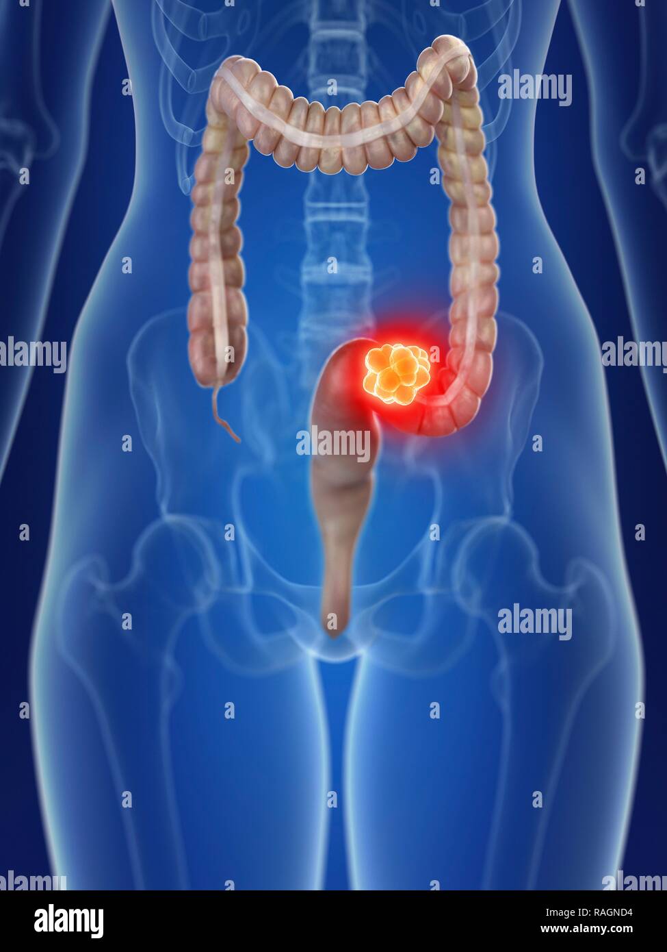 Descending colon cancer hi-res stock photography and images - Alamy