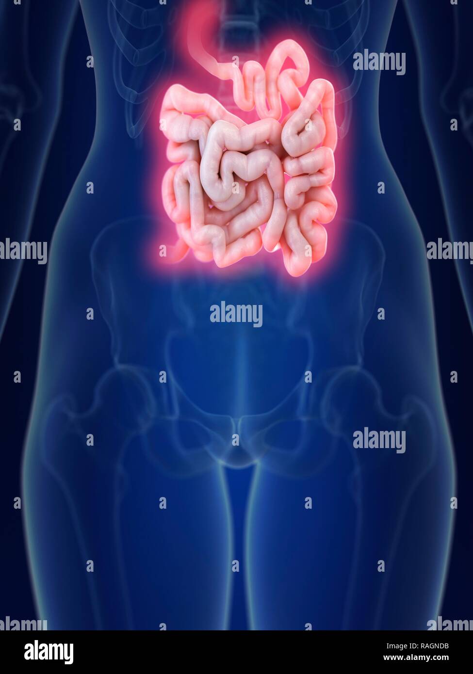Illustration of an inflamed small intestine Stock Photo - Alamy