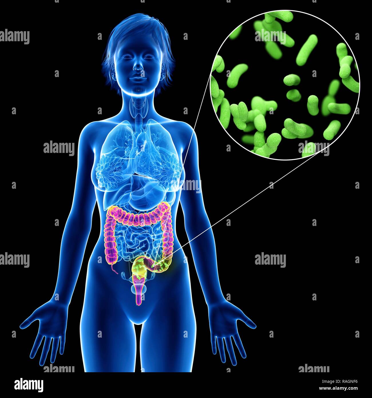 Illustration of a woman's colon infection Stock Photo - Alamy