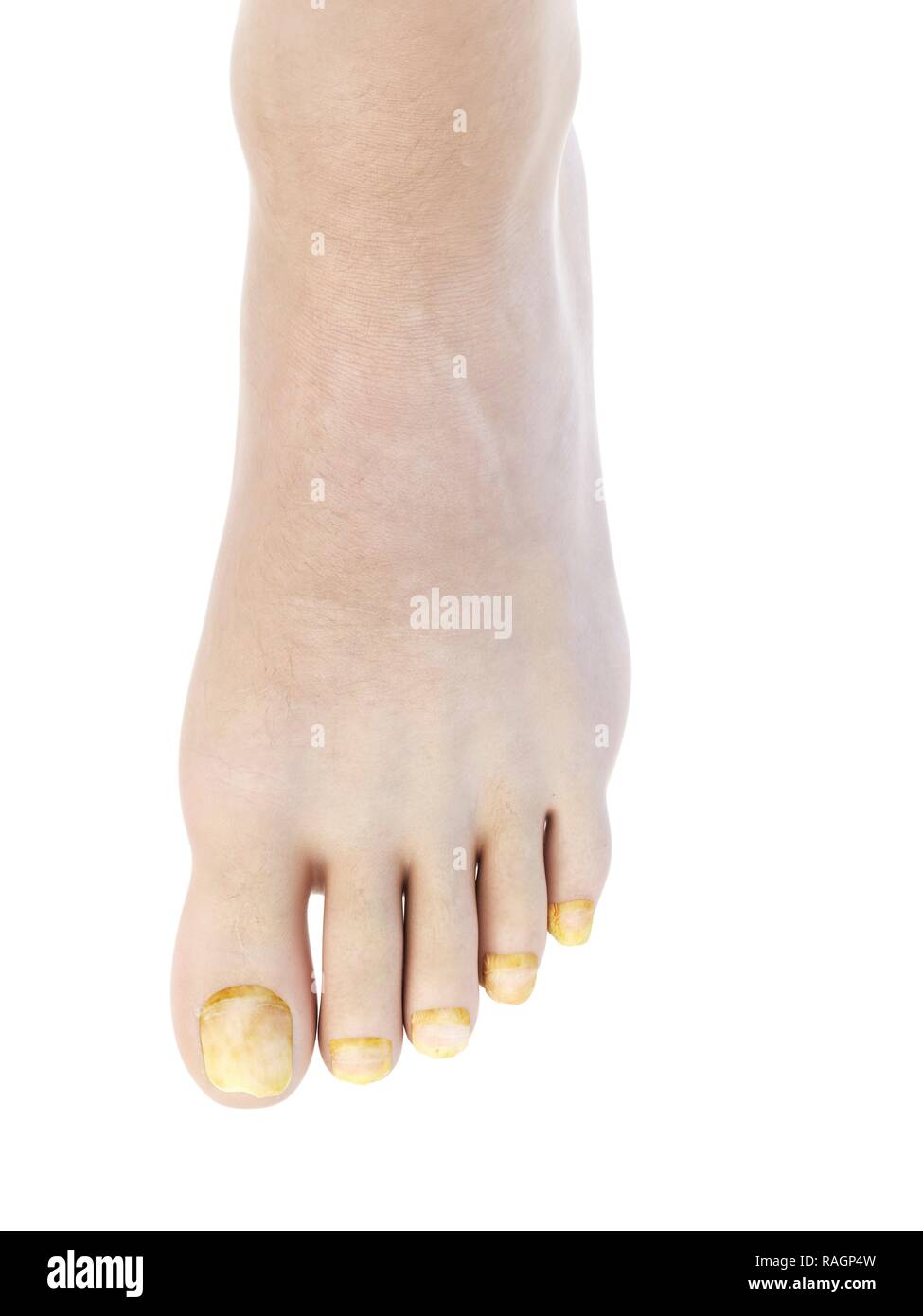 Illustration of toe nail fungus Stock Photo - Alamy