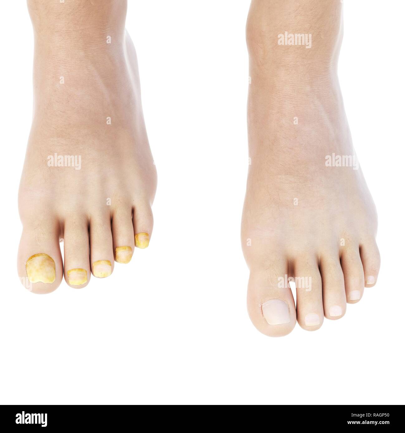 Nail fungus Cut Out Stock Images & Pictures - Alamy