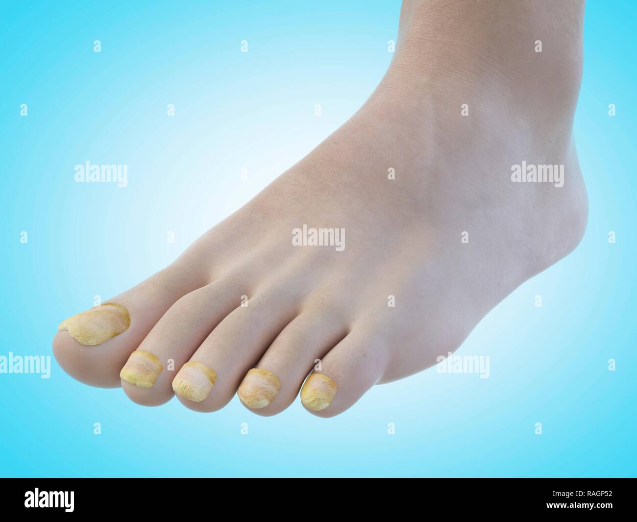 Illustration of toe nail fungus Stock Photo - Alamy