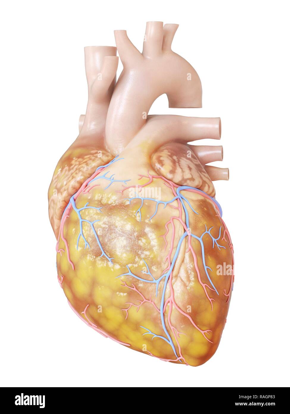 Illustration of a fatty heart Stock Photo - Alamy
