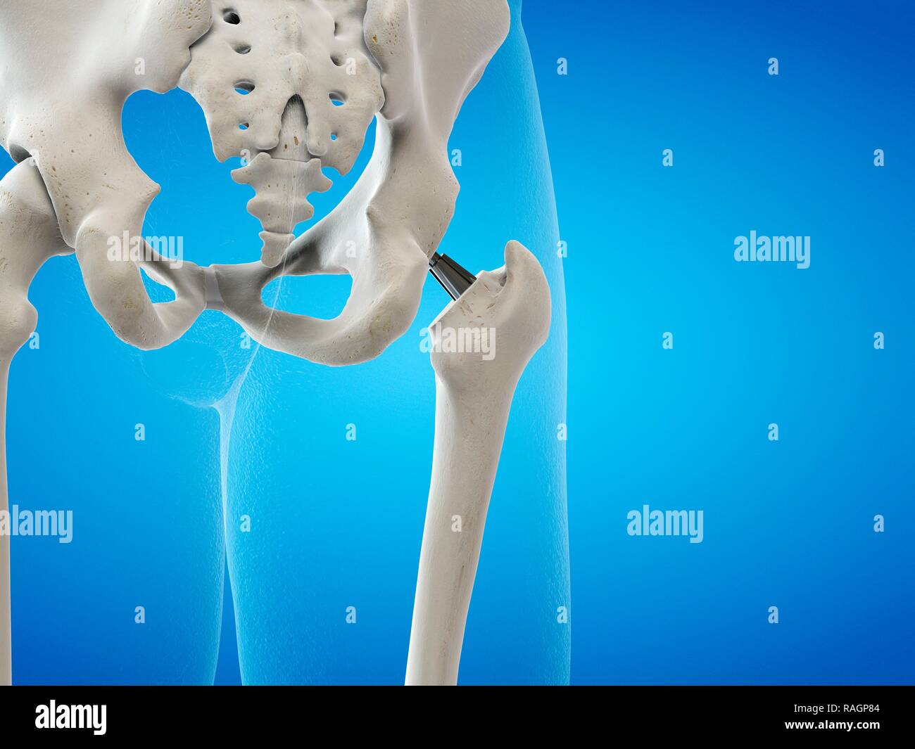 Hip replacement concept hi-res stock photography and images - Alamy