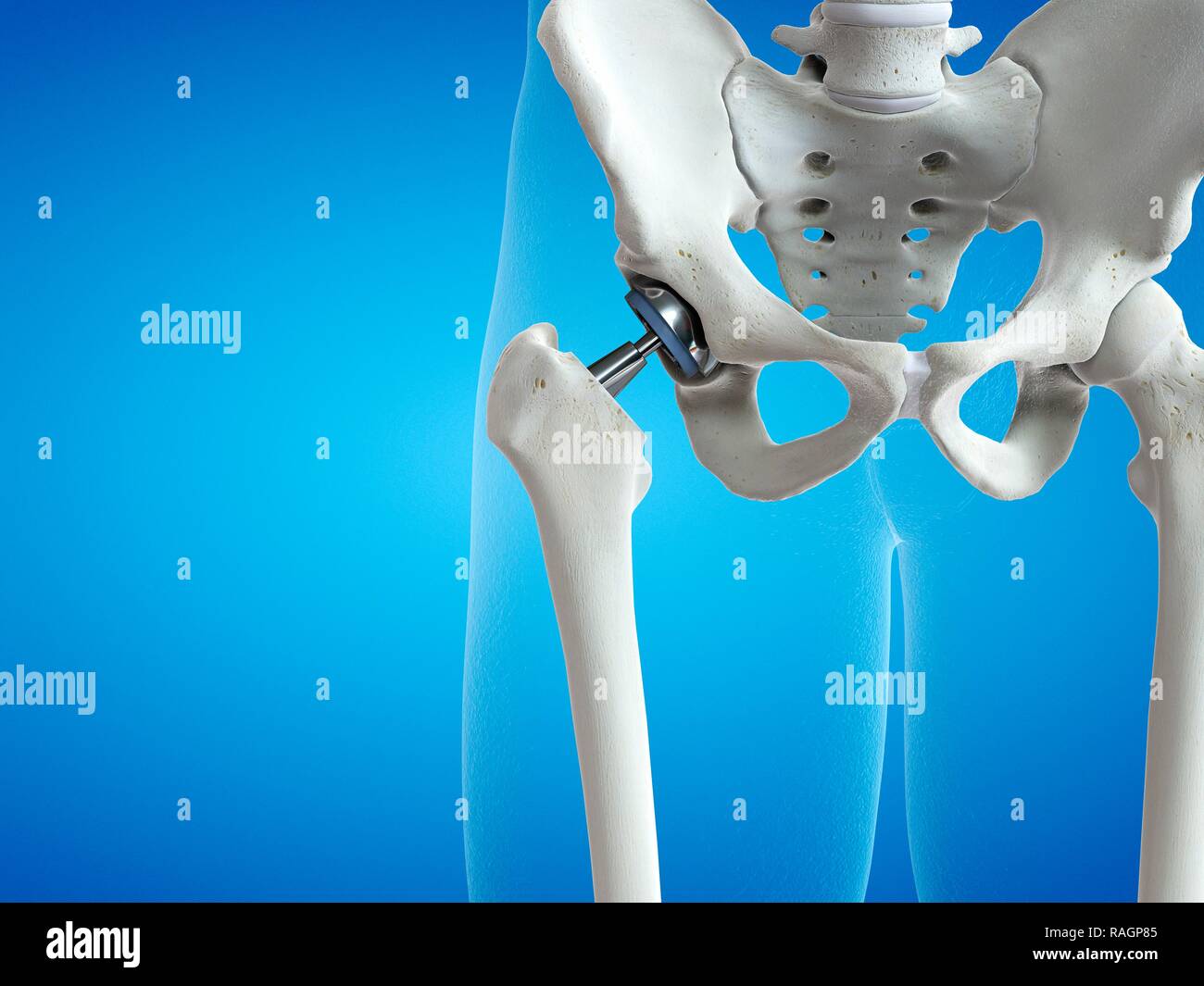 Illustration of a hip replacement Stock Photo - Alamy