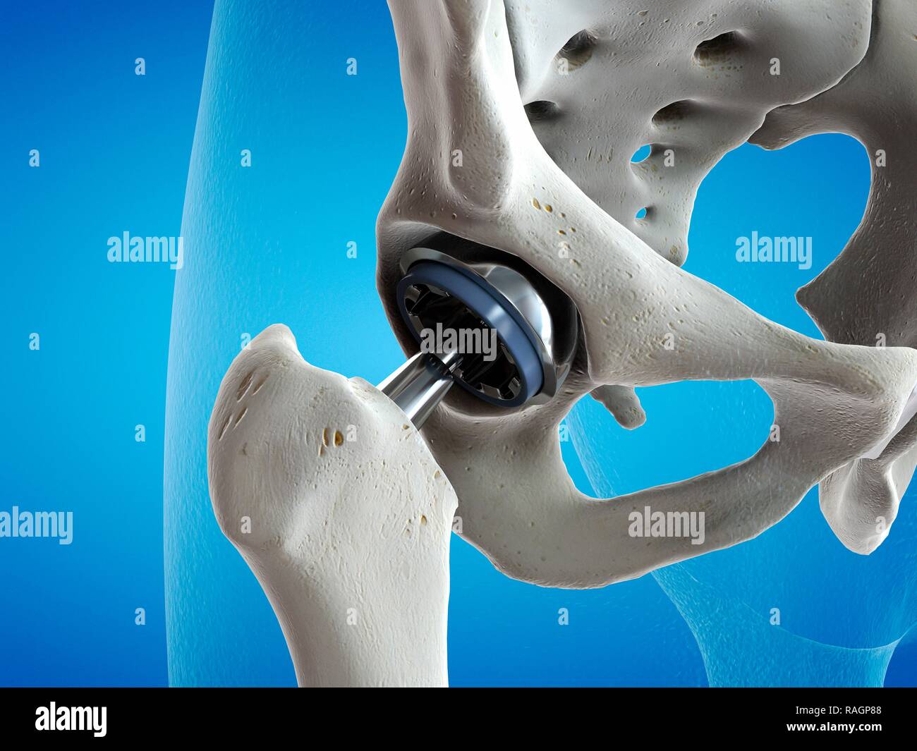 Illustration of a hip replacement Stock Photo - Alamy