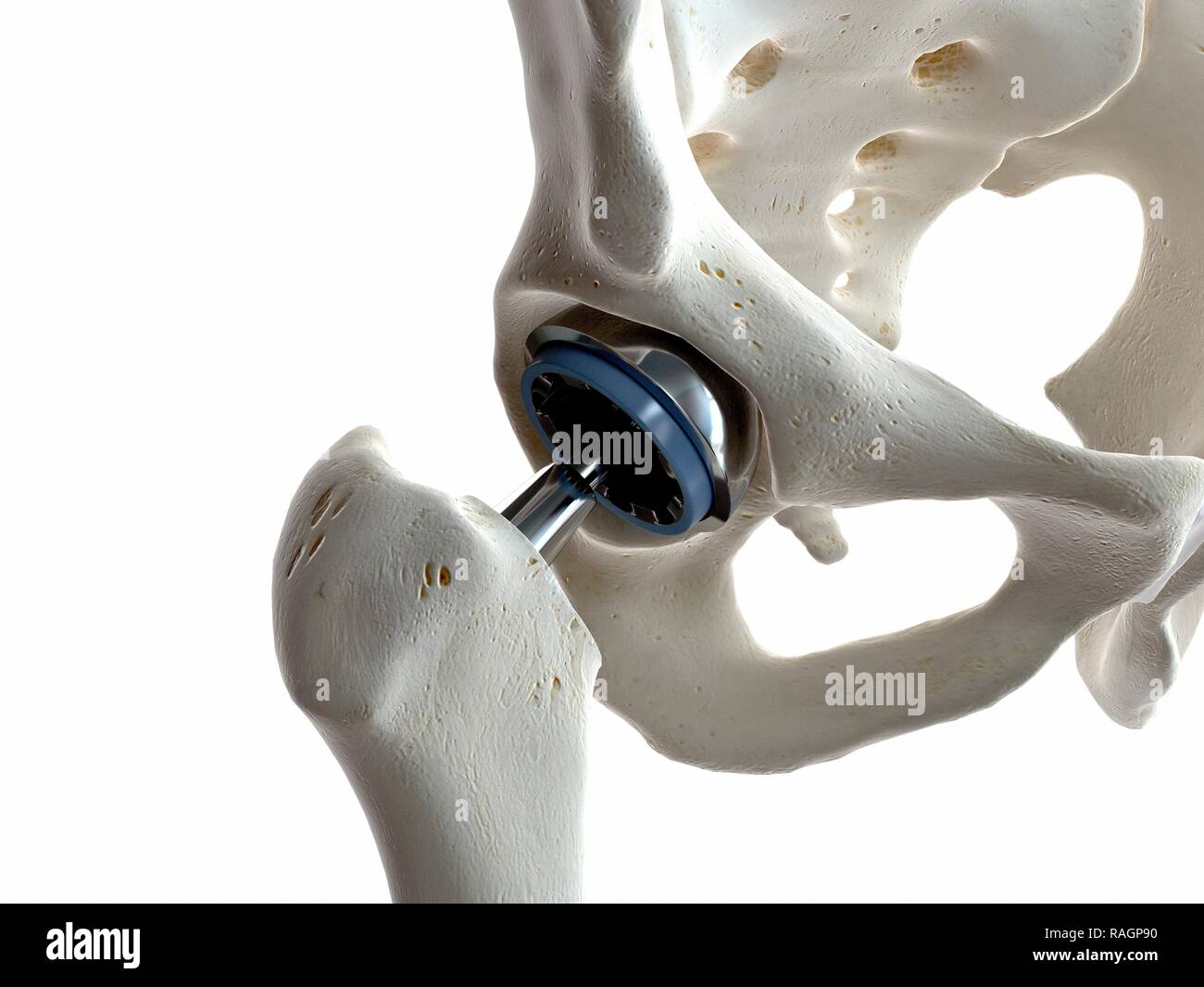 Illustration of a hip replacement Stock Photo - Alamy