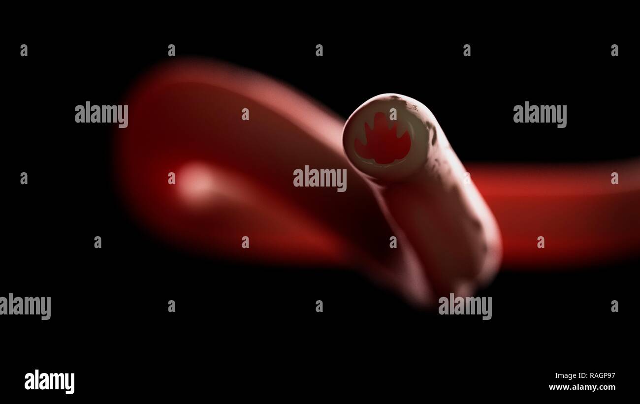 Illustration of a hookworm Stock Photo - Alamy