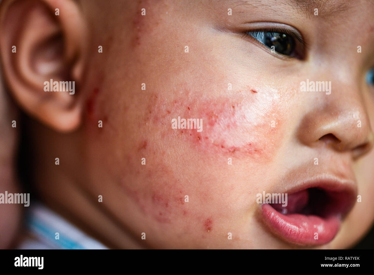 Face Skin Rash Allergy At Chelsea Elyard Blog Face Skin Rash Allergy At Chelsea Elyard Blog