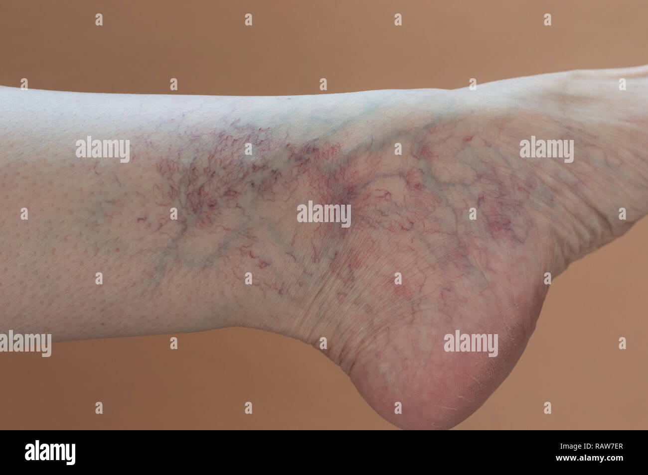 Spider Veins High Resolution Stock Photography and Images - Alamy