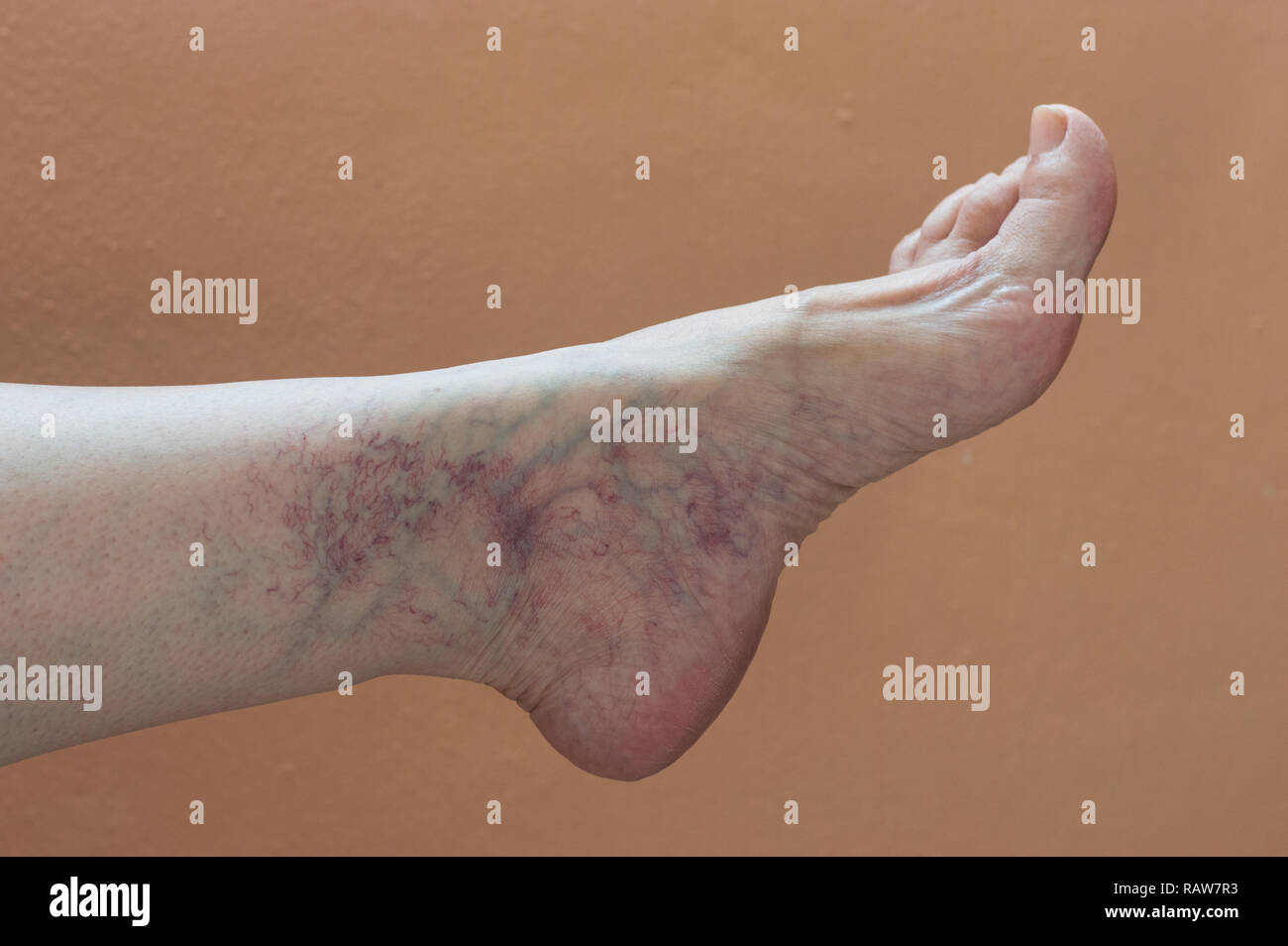 Spider veins hi-res stock photography and images - Alamy