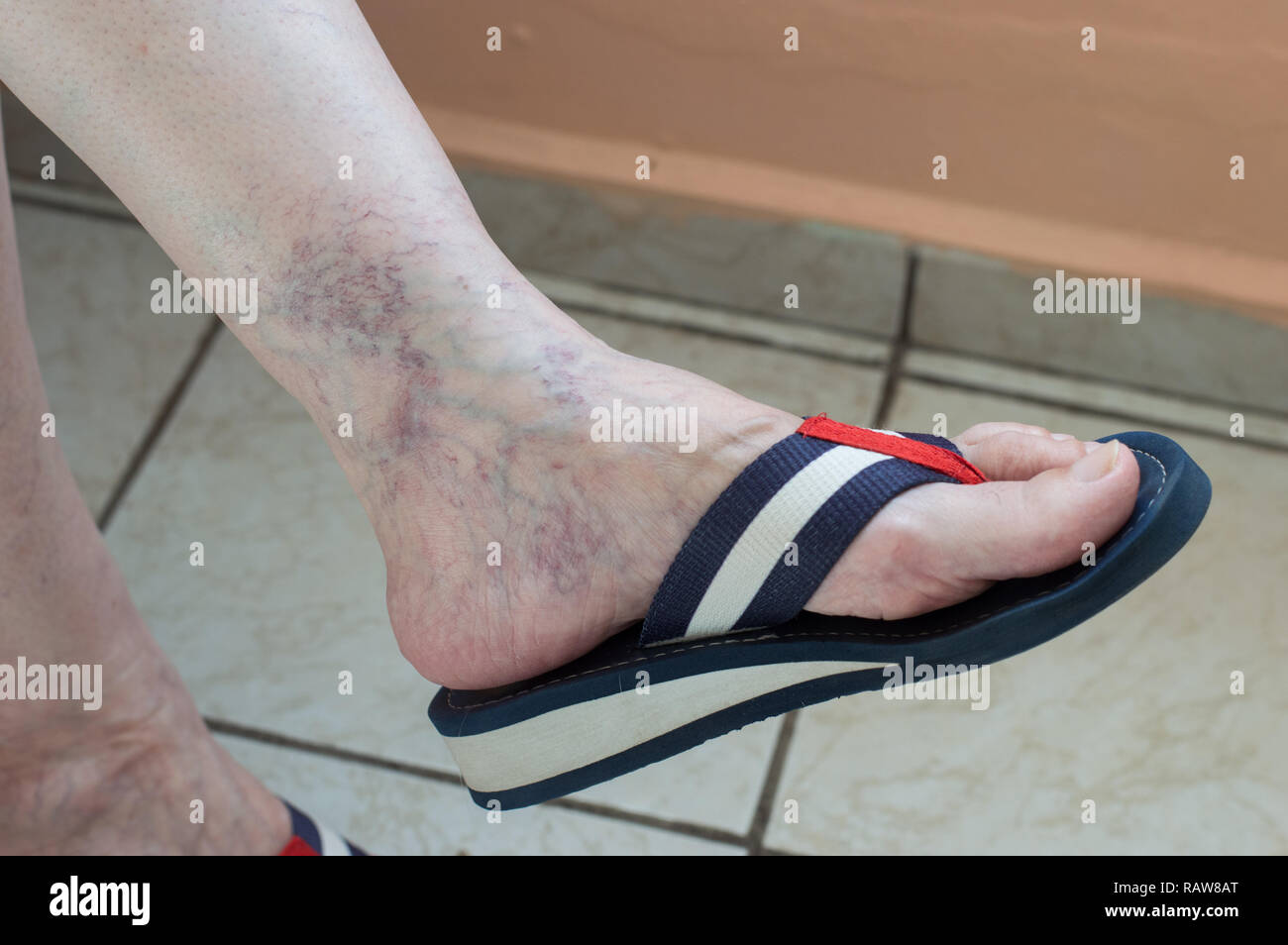 Spider Veins High Resolution Stock Photography and Images - Alamy