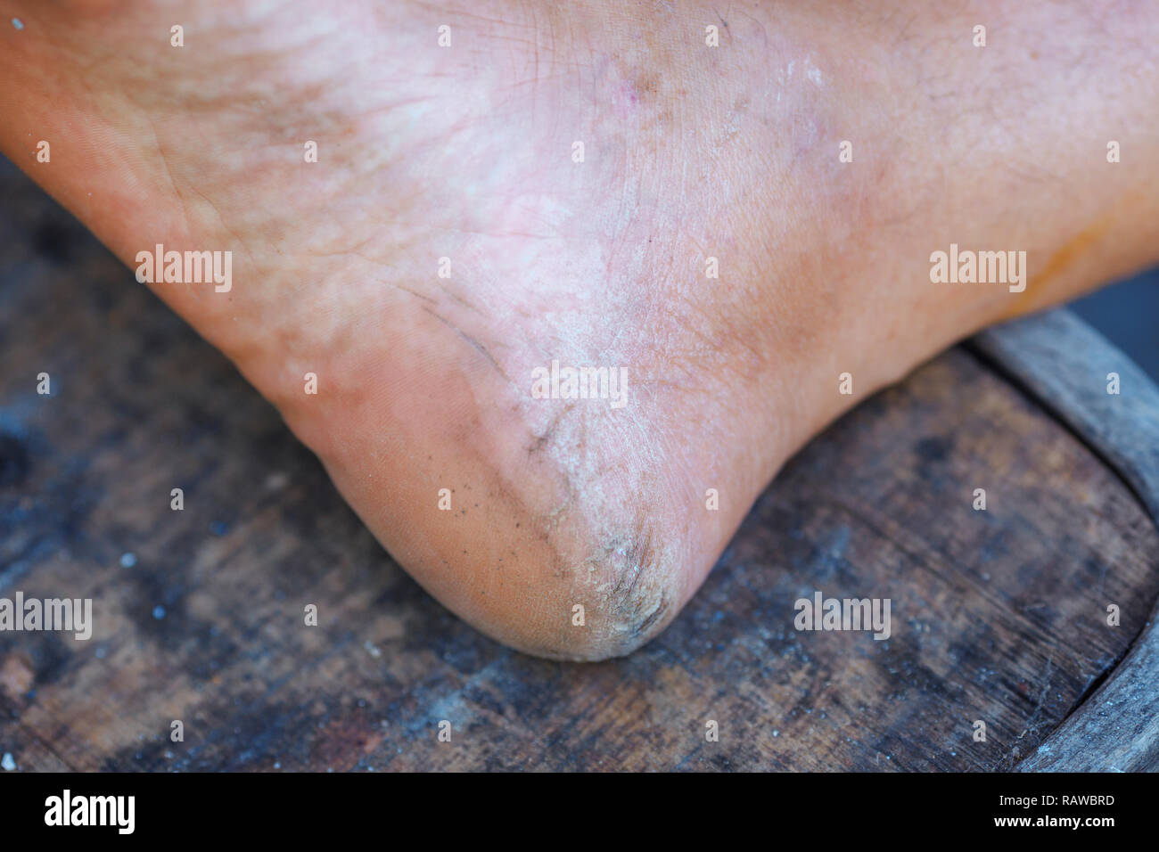Dry cracked skin woman feet hi-res stock photography and images - Alamy