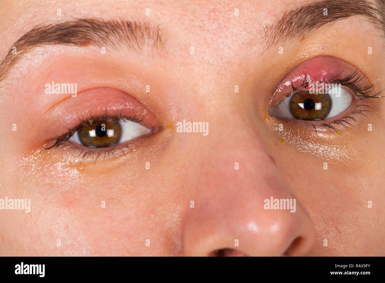 Close up picture of upper eyelid inflammation - chalazion - young ...