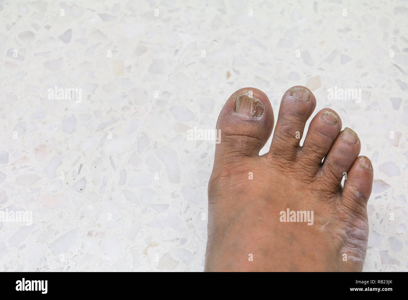 Big toe fracture hi-res stock photography and images - Alamy