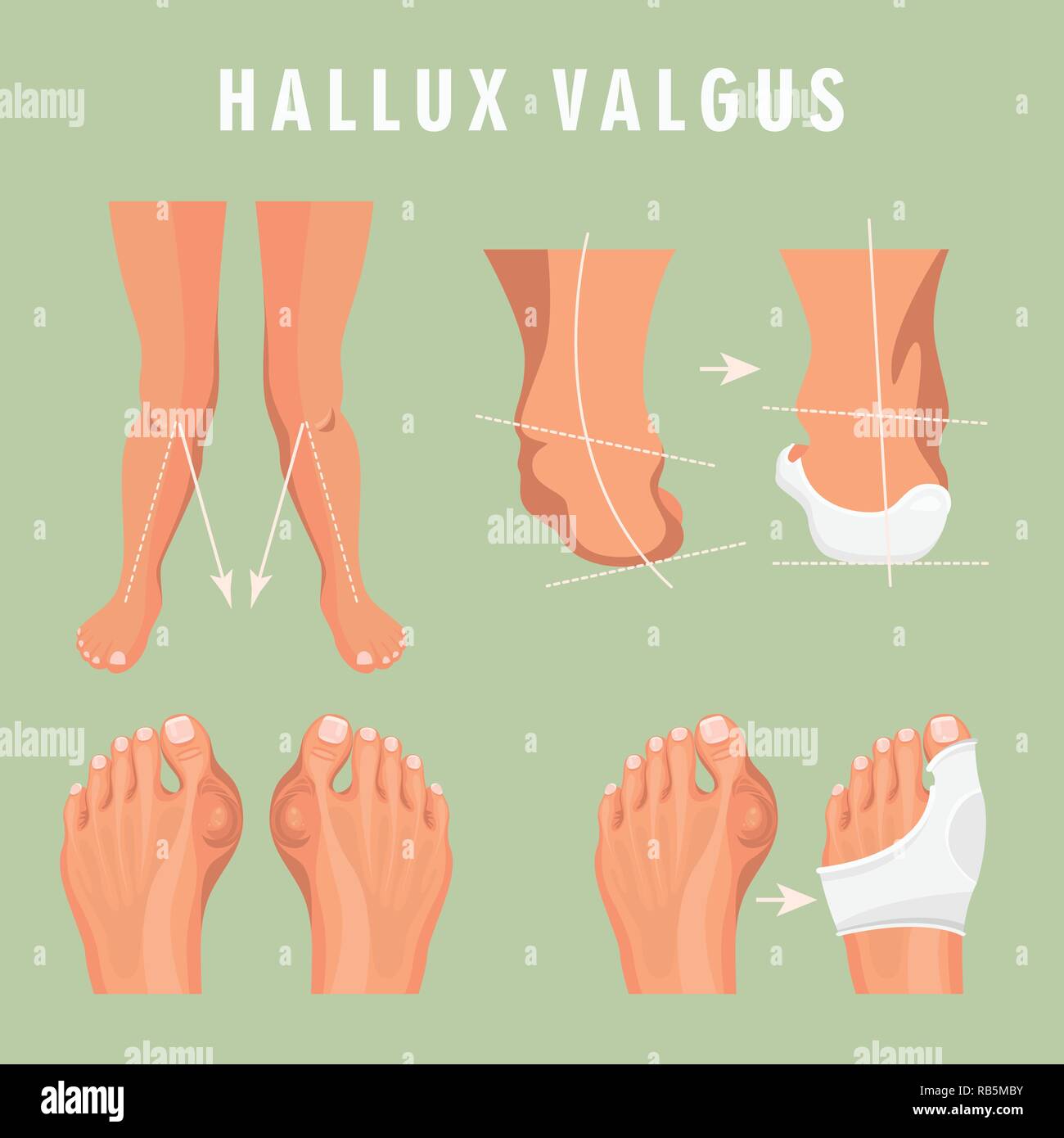 Valgus Deformity High Resolution Stock Photography and Images - Alamy