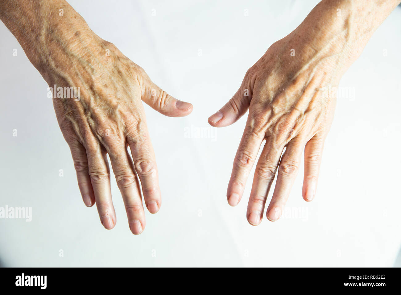 Age spots hands hi-res stock photography and images - Alamy